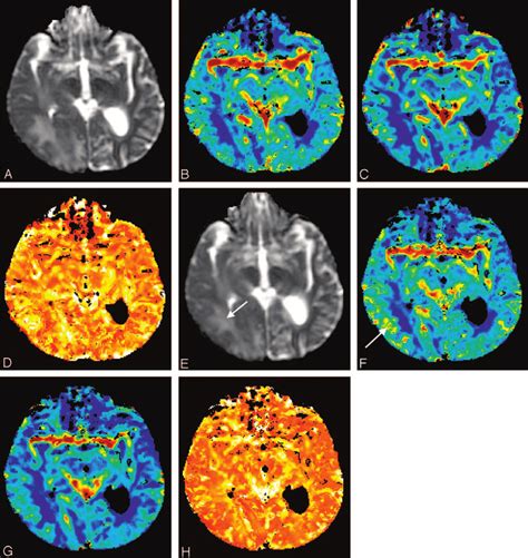 Images Obtained From Patient 4 [d] A And E Cbf B And F Cbv C Download Scientific