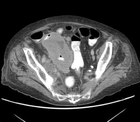 A 84­year­old Woman With Histiocytic Sarcoma One Year After Download Scientific Diagram