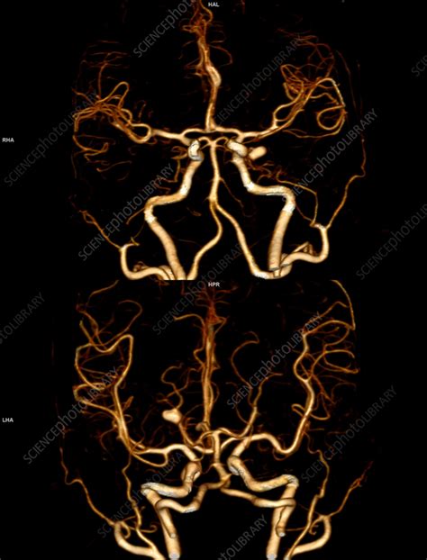 Cerebral Artery Aneurysm 3d Angiograms Stock Image F045 3086 Science Photo Library