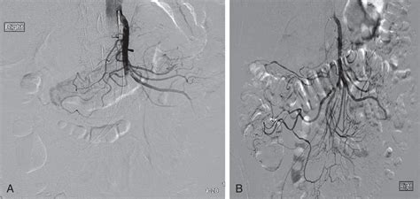 Mesenteric Ischemia Clinical Tree