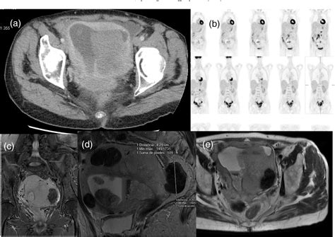 Figure 1 From Primitive Neuroectodermal Tumor Of The Uterus Semantic Scholar