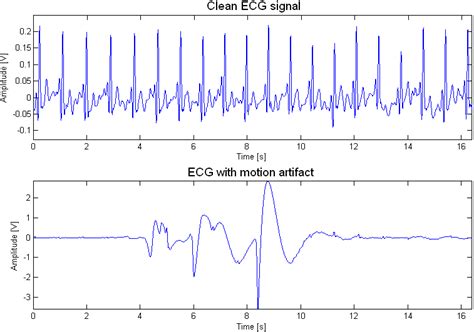 Results For Capacitive Ecg Acquisition With The Electrodes Embedded In