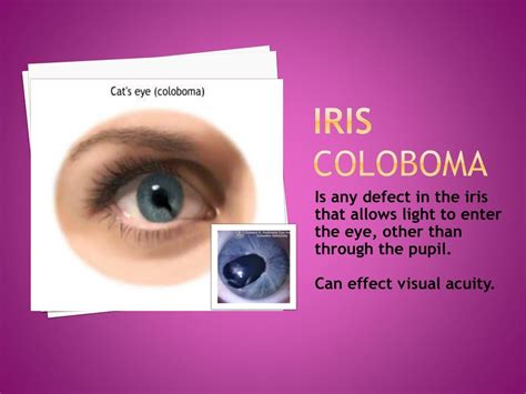 Ppt Coloboma Sfa Group Powerpoint Presentation Free Download Id409409