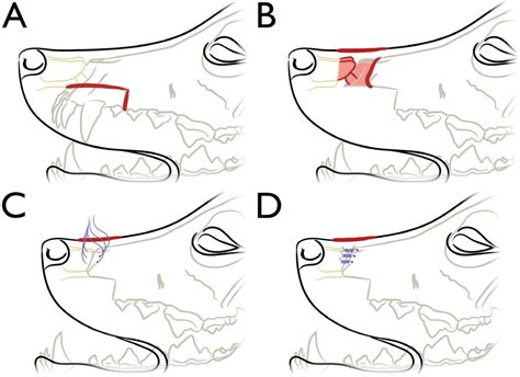 Muzzle Shortening Rhinoplasty As A Novel Reconstructive Technique To