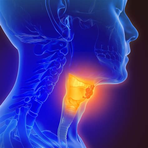 The Link Between Hpv And Throat Cancer