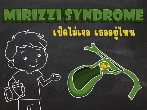 Mirizzi Syndrome โคตรเด๋อ ไทยแลนด์ Coder Thailand Facebook