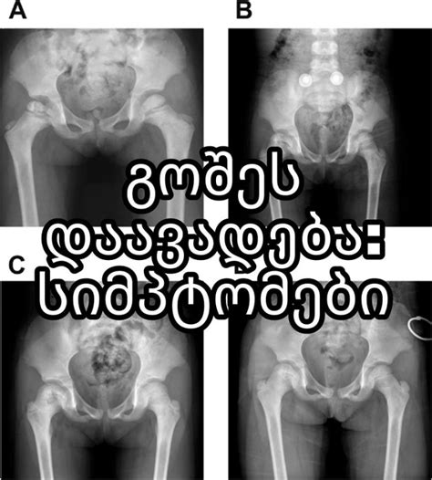 გოშეს დაავადება