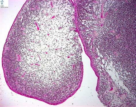 Botryoid Rhabdomyosarcoma Human Pathology