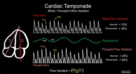 Cardiac Tamponade Em Ultrasound Section
