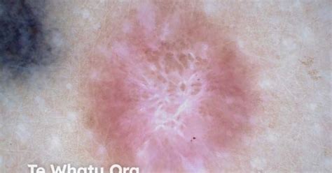 Dermatofibroma Polarised Dermoscopy View Image