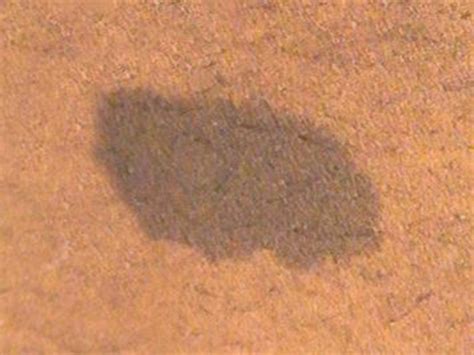 Derm Terms And Pics Flashcards Quizlet