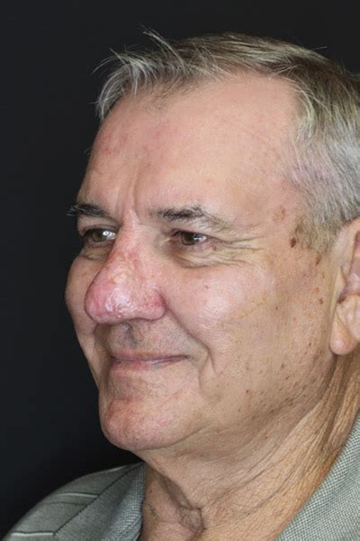 Rhinophyma Before And After Photos Raggio Md Facial Plastic Surgery