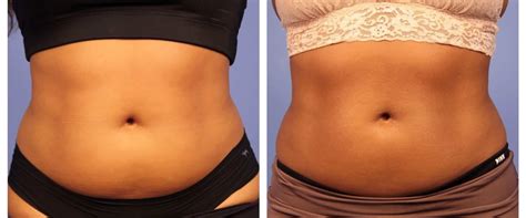 How Effective Is Coolsculpting For Belly
