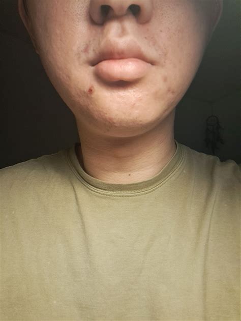 모낭염 지루성피부염 치료 후기