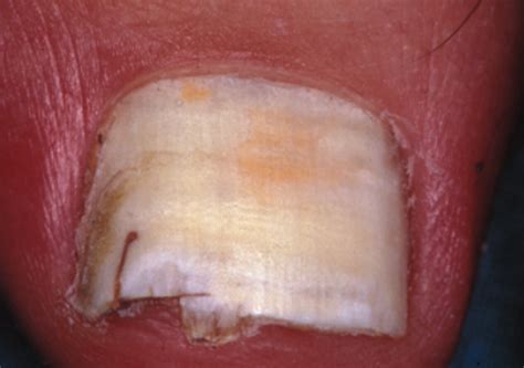 White Superficial Onychomycosis Nail Fungus At Betty Coleman Blog
