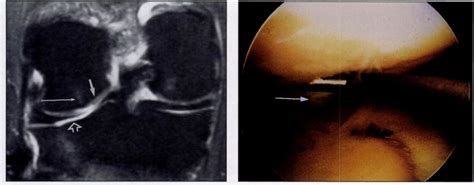 60 Year Old Woman With Grade 3 Chondromalacia A Coronal 12 Weighted