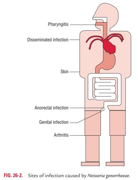 Clinical Syndromes Neisseria Gonorrhoeae