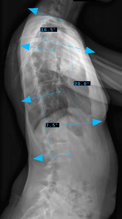 Lenke Class 4cn Harms Study Group