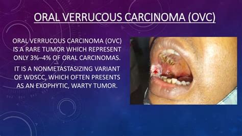 Oral Verrucous Carcinoma Ovc Pptx