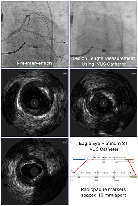 Case 13 Ostial Lcx Stenting And Stent Sizing Cardiology Apps