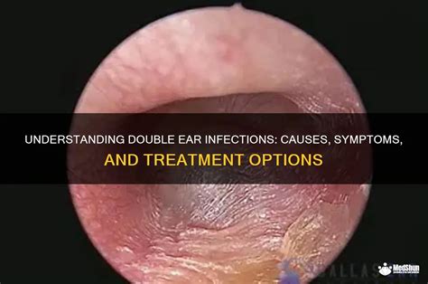 Understanding Double Ear Infections Causes Symptoms And Treatment
