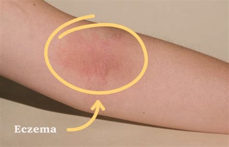 Eczema On Elbow Crease Eczema On Arms And Elbows Managing Symptoms