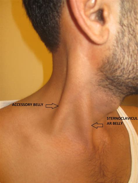 Sternocleidomastoid
