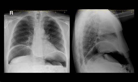 Pneumoperitoneum Pneumothorax And Pneumoretroperitoneum Post