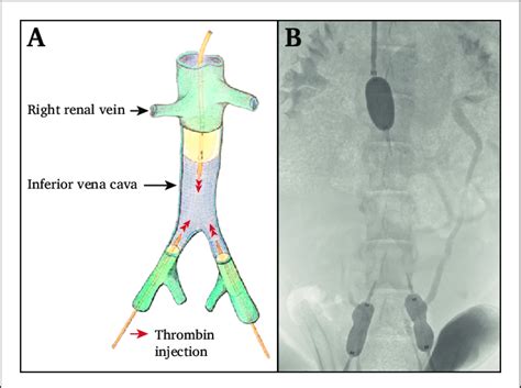 A Scheme And B Digital Subtraction Angiography Showing The