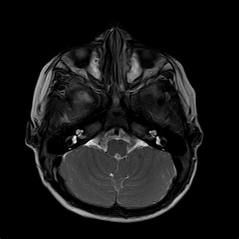 15 Months Mri Atlas Of Normal Myelination
