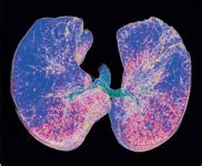 Let S Talk About Sex In Interstitial Lung Disease The Lancet Rheumatology