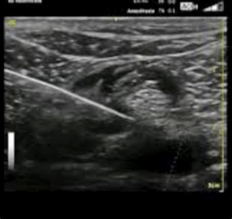 Hydrodissection Does Not Have To Be A Pain Ultrasound Guided Treatment Hydrodissection Does Not Have To Be A Pain Ultrasound Guided Treatment