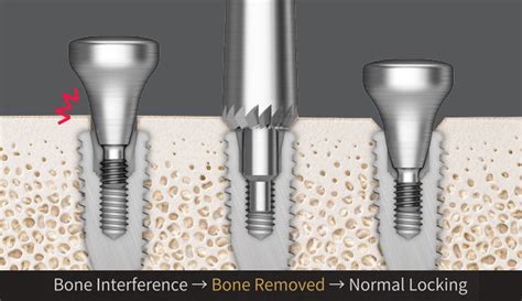 Osstem Uk Assist Kit