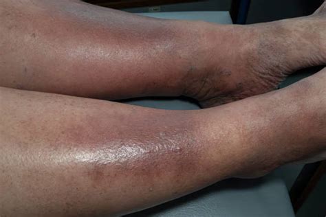 Venous Stasis Dermatitis Understanding Causes And Treatment