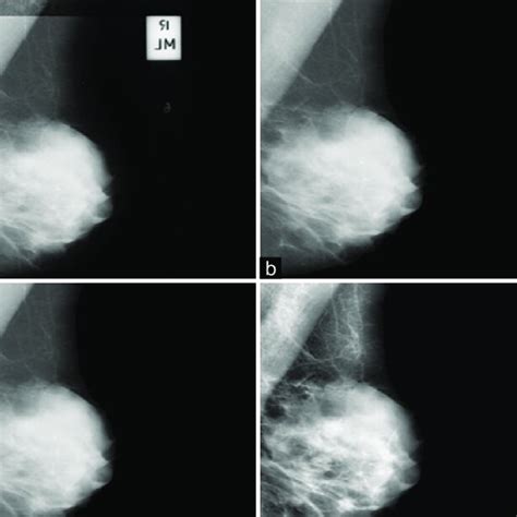 Pre Processing Stepa Original Mammogram Image B Label Removed
