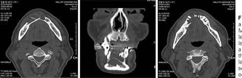 Figure 2 From Botryoid Odontogenic Cyst On Mandibular Anterior And Both