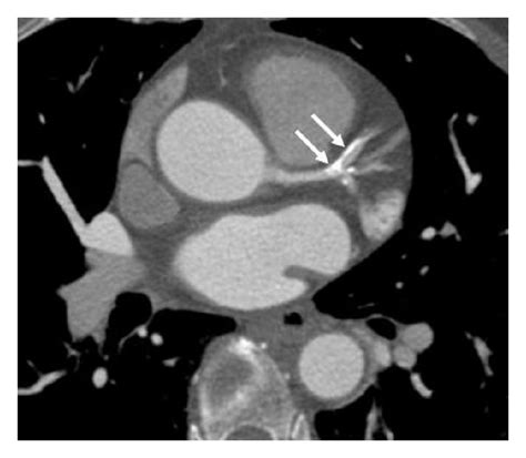 Vie Appearance Of Calcified Plaques An Eccentric Calcified Plaque Is