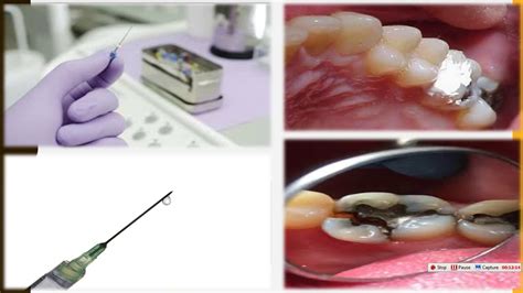 Pain And Flare Up After Endodontic Treatment Procedures At Grace