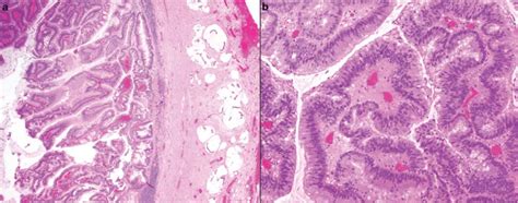 A Appendix Demonstrating A Primary Appendiceal Mucinous Neoplasm With Download Scientific