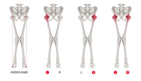 Valgus Alignment Leg Or Knockknee Red Highlights On Hip Joint Area