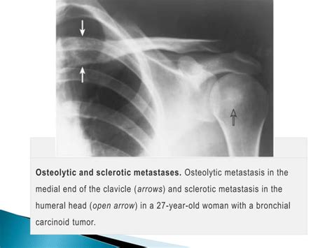 Metastatic Bone Disease Pptx