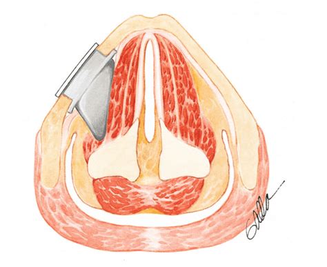 Montgomery Thyroplasty Implant System Soluvos Medical Laryngology