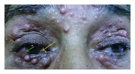 Clockwise From Left Nodular Lesions Involving The Face In A
