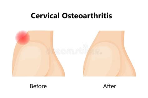 Cervical Osteochondrosis Medical Care Before And After Stock Vector Illustration Of Spine
