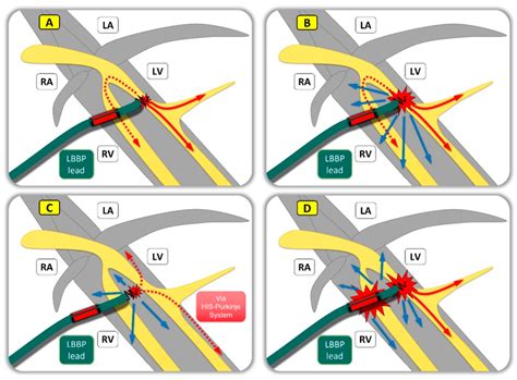 Left Bundle Branch Area Pacing Lbbap Figure 2 Shows Possible Download Scientific Diagram