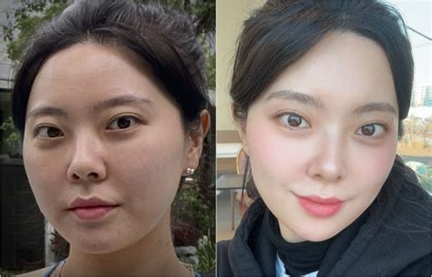 얼굴실리프팅 청담5g 리프팅 팔자주름심부볼이중턱살제거까지 눈밑꺼짐필러 유스필 후기 네이버 블로그
