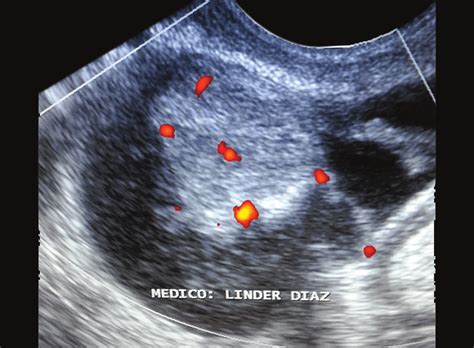 Adnexal Mass Classified As Gi Rads 5 There Were Three Suspicious