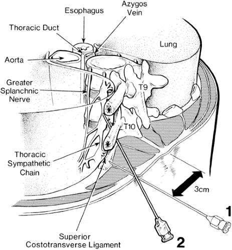 Sympathetic Neural Blockade Of Upper And Lower Extremity Anesthesia Key