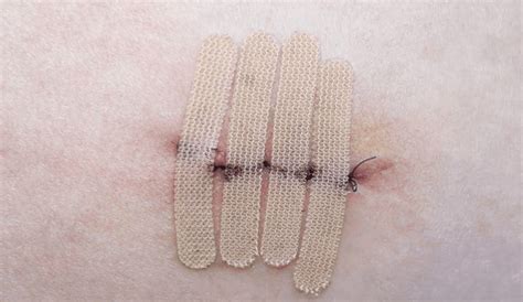 Low Recurrence Seen For Excision Of Melanoma In Situ With 5 Mm Margin