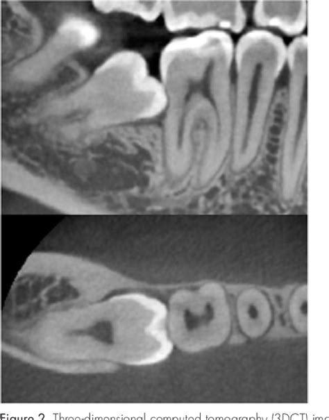 Figure 2 From Treatment Of Mandibular Second Molar Impaction In A Patient With Metal
